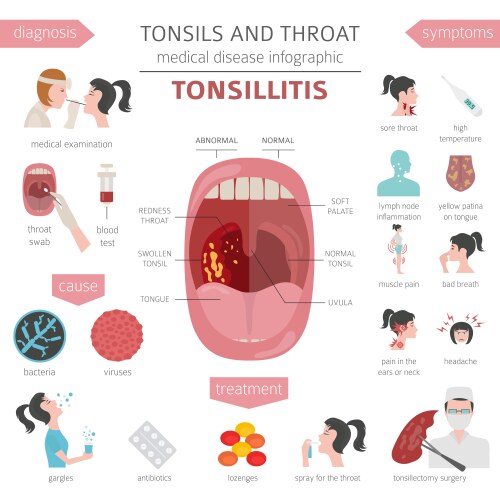 Tonsillitis red and swollen tonsils white spots Vector Image