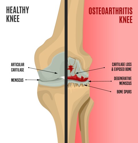 Knee Osteoarthritis Poster Royalty Free Vector Vectorstock