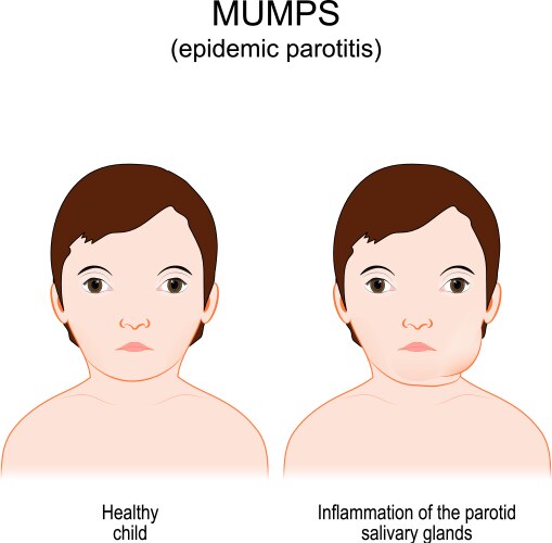 Mumps Vector Images (over 550)