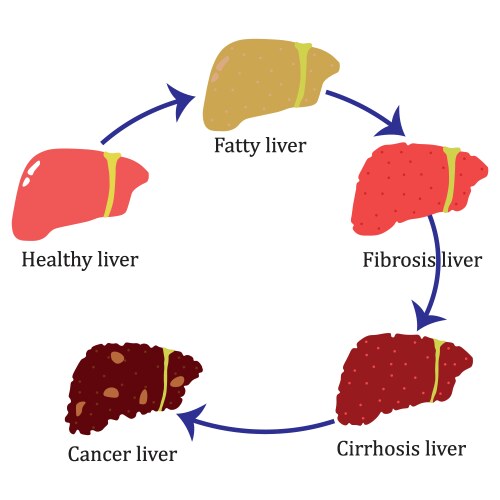 Liver Cancer Infographic Vector Images (over 310)