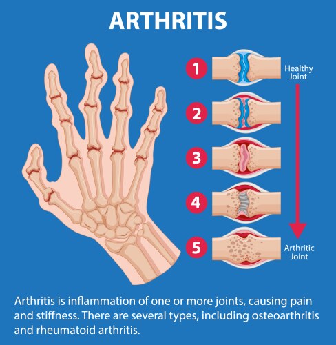 Science education of human anatomy arthritis Vector Image