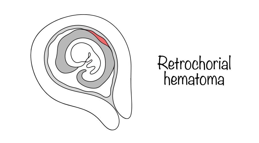 Hematoma Vector Images & Graphics for Commercial Use | VectorStock