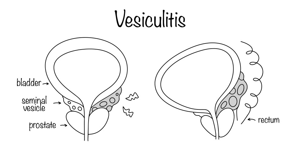 Urethritis Royalty Free Vector Image - VectorStock