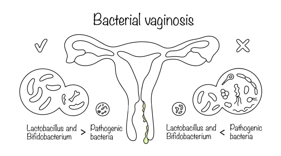 Bacterial vaginosis Royalty Free Vector Image - VectorStock