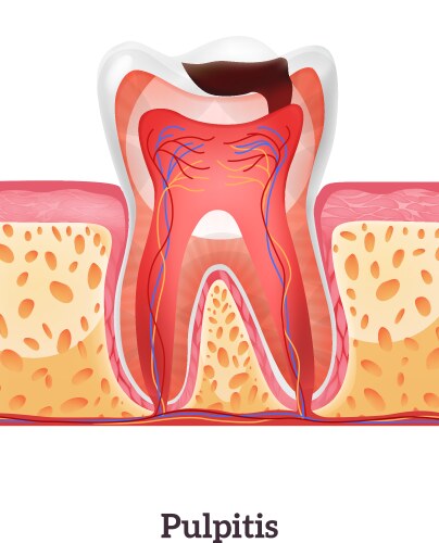 Periodontitis dental disease inflammation Vector Image