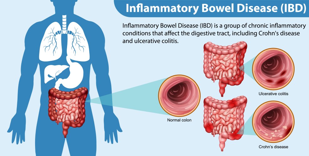 Inflammatory bowel disease ibd infographic Vector Image