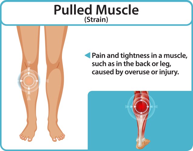 Muscle Strain Vector Images (over 730)