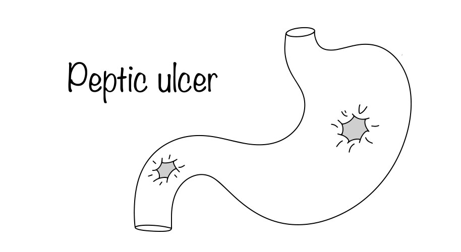 Peptic Ulcers Vector Images (over 250)