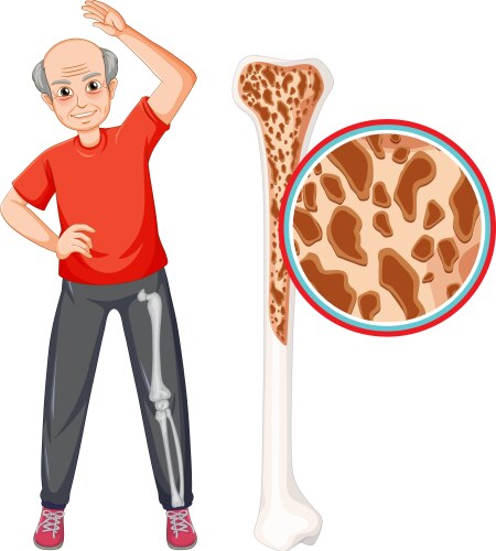 Causes osteoporosis and bone loss Royalty Free Vector Image