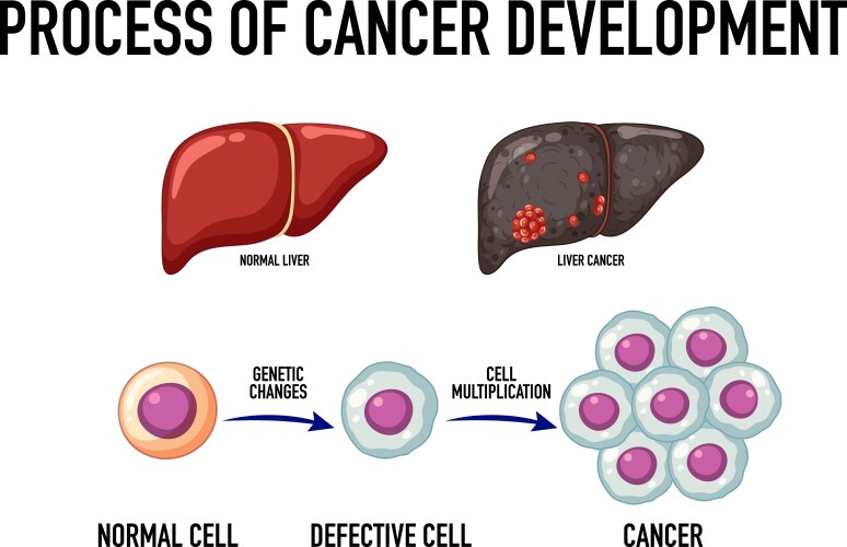 Liver cancer symptoms Royalty Free Vector Image