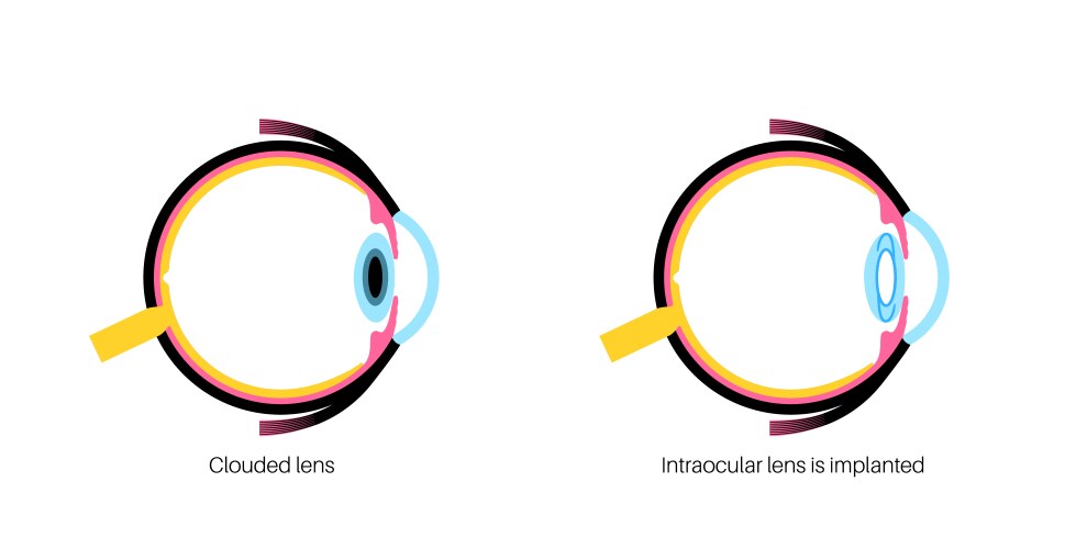 Intraocular lenses poster Royalty Free Vector Image