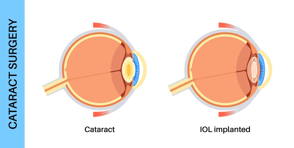 Intraocular lenses poster Royalty Free Vector Image
