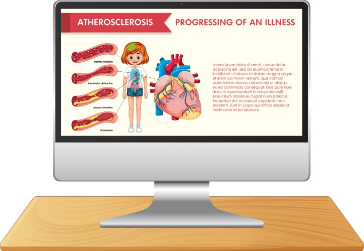 Realistic atherosclerosis infographic Royalty Free Vector