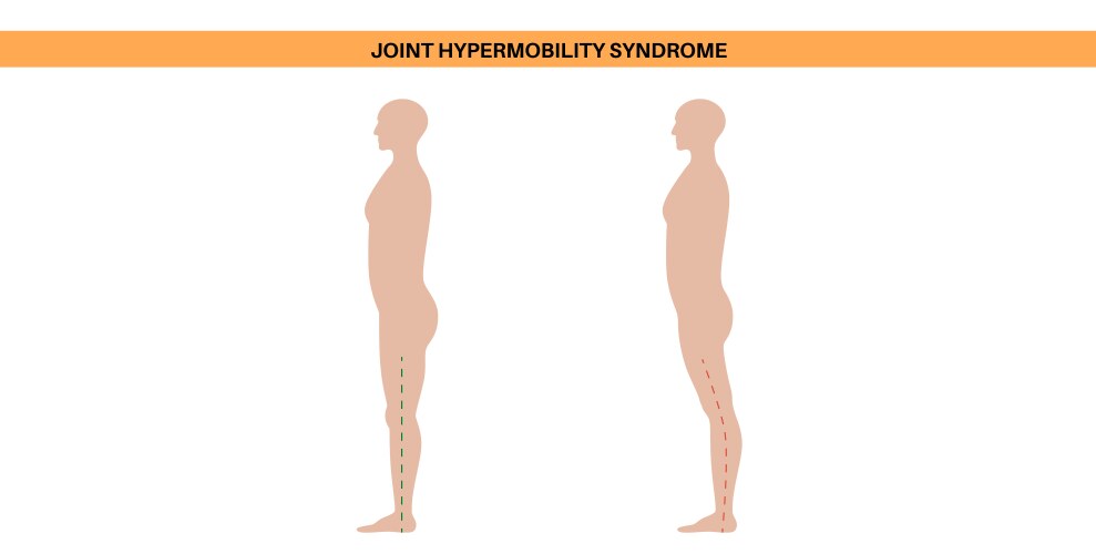 Joint hypermobility poster Royalty Free Vector Image