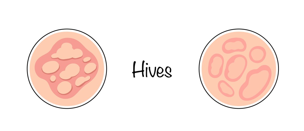 Hives Vector Images (over 36,000)