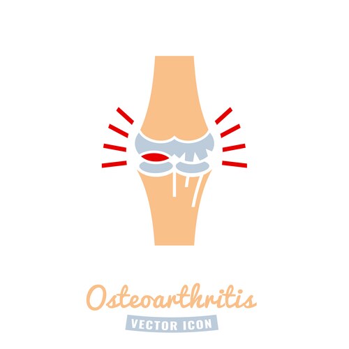 Knee Osteoarthritis Poster Royalty Free Vector Vectorstock