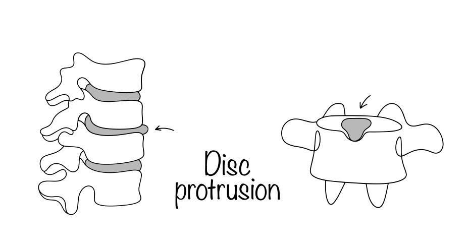 Disk Herniation Vector Images (69)