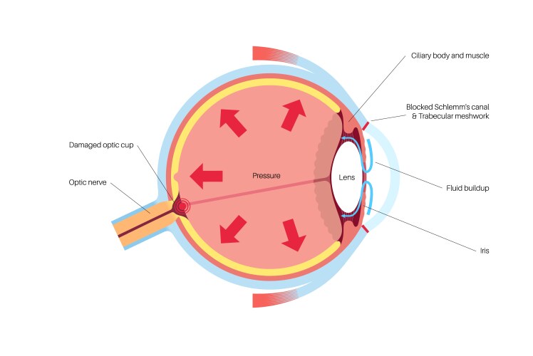 Glaucoma eye pressure Royalty Free Vector Image
