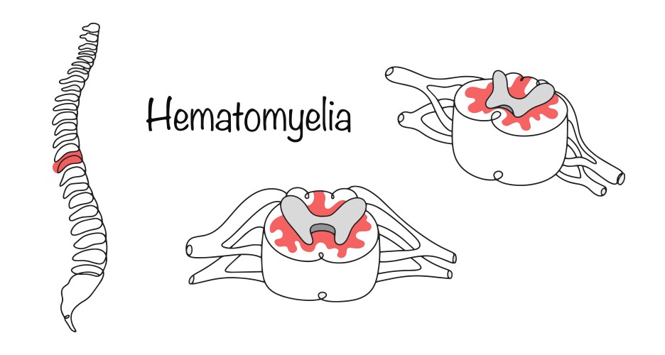 Blood in stool Royalty Free Vector Image - VectorStock