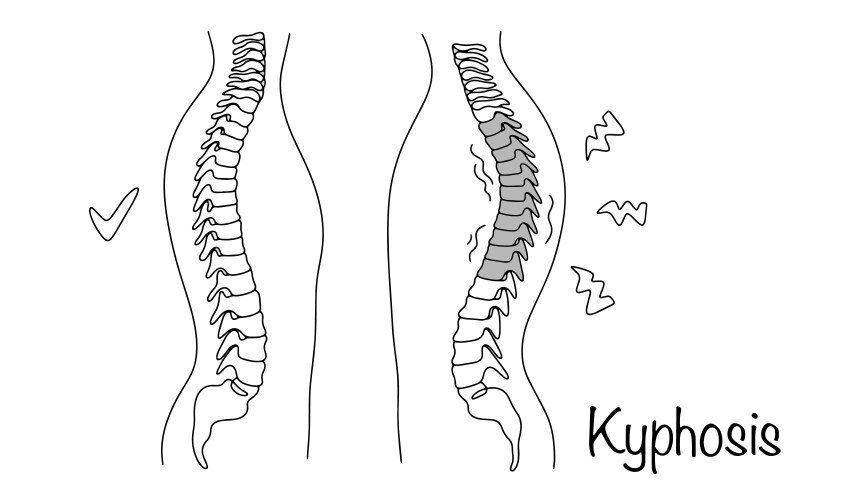 Kyphosis Vector Images (over 490)