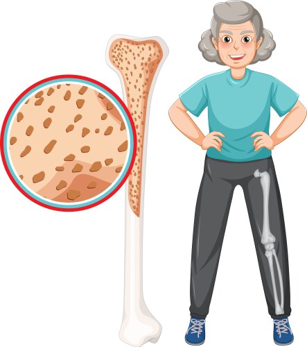 Causes osteoporosis and bone loss Royalty Free Vector Image