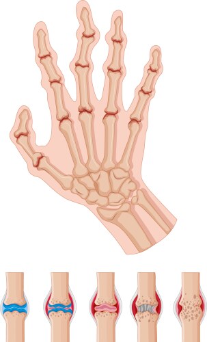Scientific medical rheumatoid arthritis Royalty Free Vector