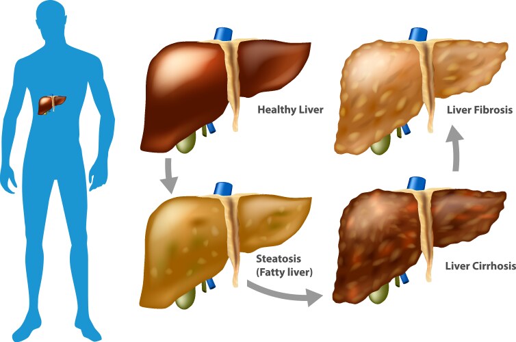 Stages liver disease leading to cirrhosis Vector Image