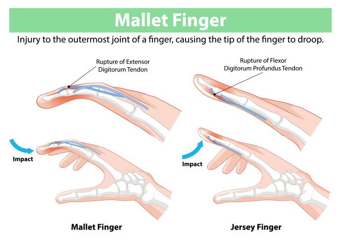 Finger tendon injuries and impacts Royalty Free Vector Image