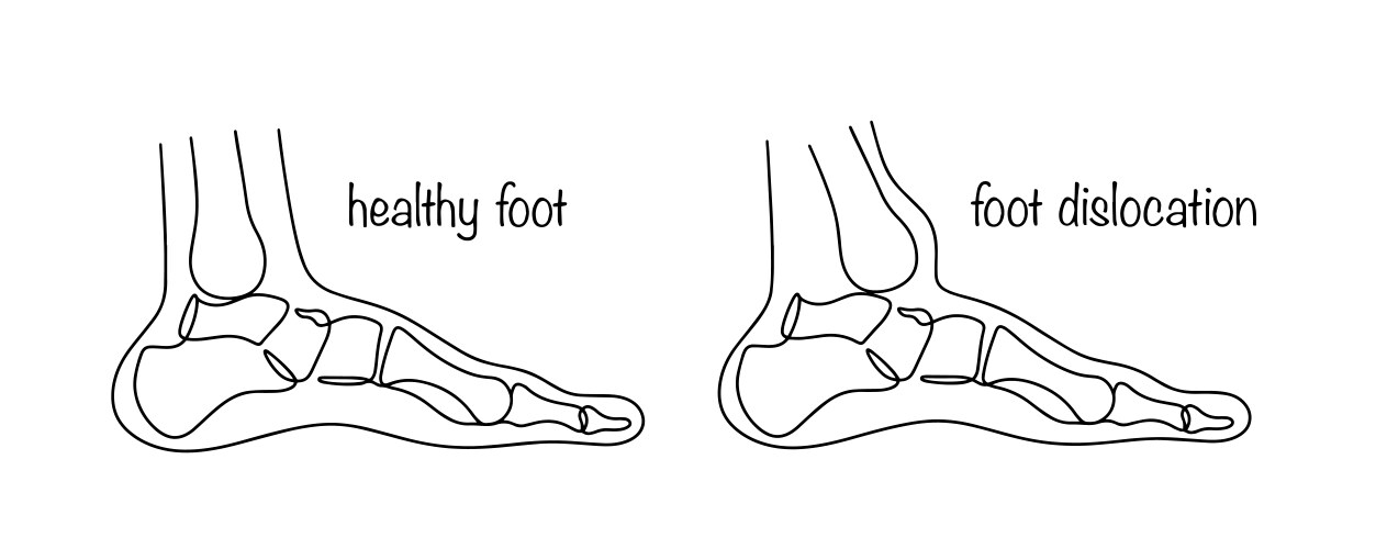 Types of foot fractures Royalty Free Vector Image