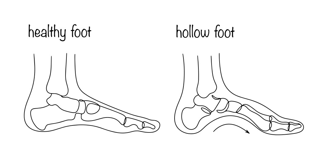 Foot Arches Vector Images (over 620)