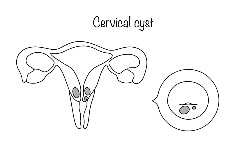 Paraovarian cyst Royalty Free Vector Image - VectorStock