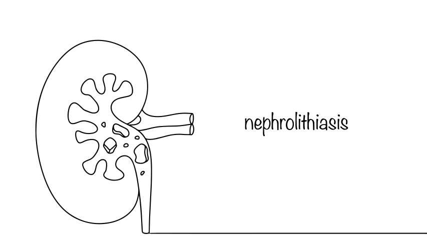 Renal cyst Royalty Free Vector Image - VectorStock