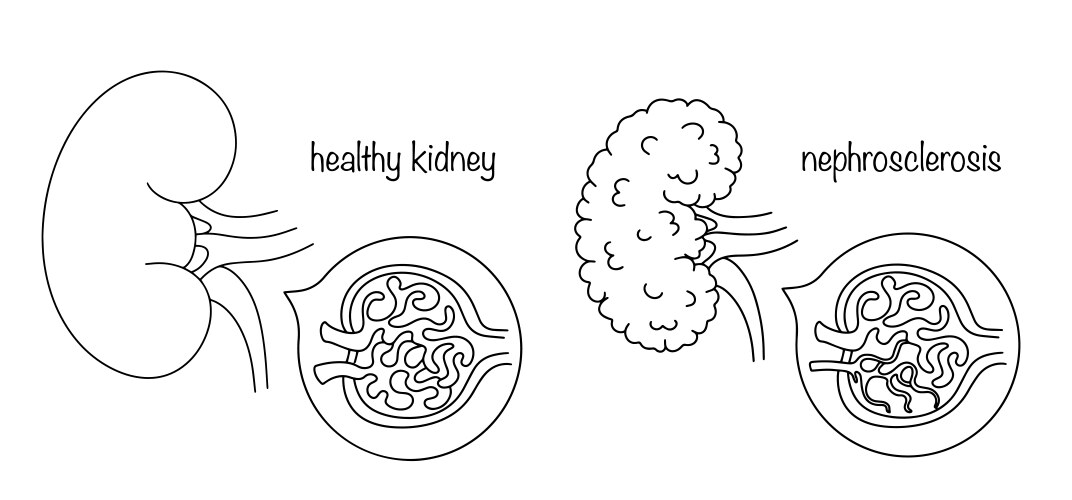 Nephrolithiasis Royalty Free Vector Image - VectorStock
