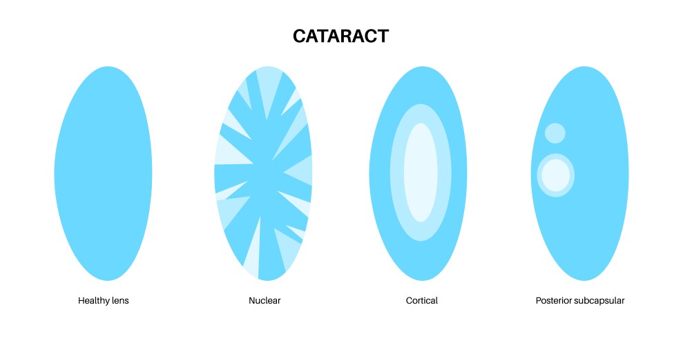 Cataract eye disease Royalty Free Vector Image