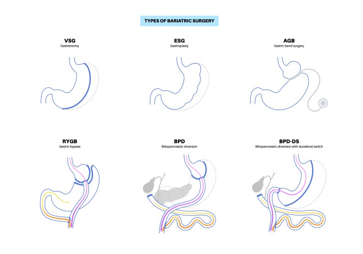 Bariatric Surgery Vector Images (over 400)