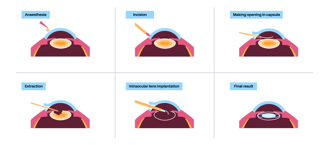 Cataract surgery poster Royalty Free Vector Image