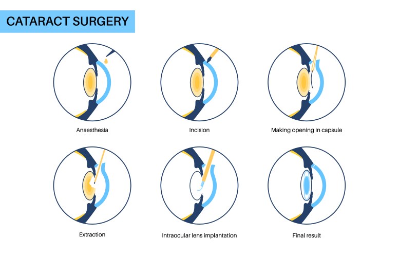 Cataract surgery poster Royalty Free Vector Image