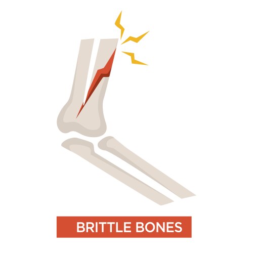 Osteoporosis stages Royalty Free Vector Image - VectorStock