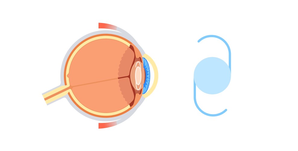 Intraocular lens poster Royalty Free Vector Image