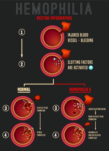 Blood Clotting Vector Images (over 1,800)
