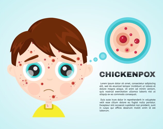 Chicken pox symptoms infographic Royalty Free Vector Image