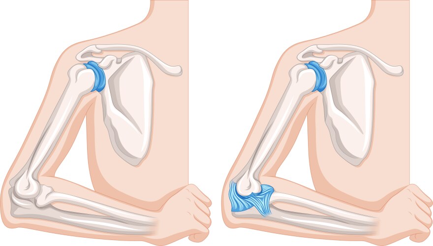 Elbow Joint Vector Images (over 2,200)