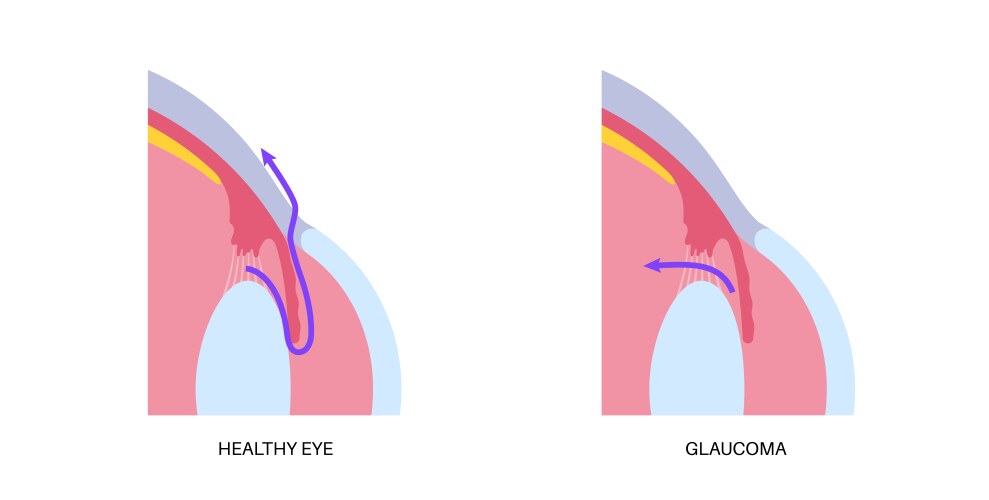 Glaucoma eye disease Royalty Free Vector Image