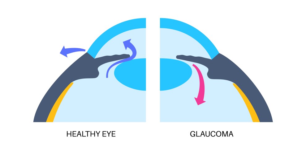 Glaucoma eye disease Royalty Free Vector Image