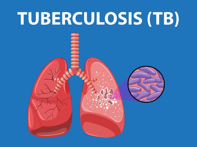 Tuberculosis Cartoon Vector Images (over 880)