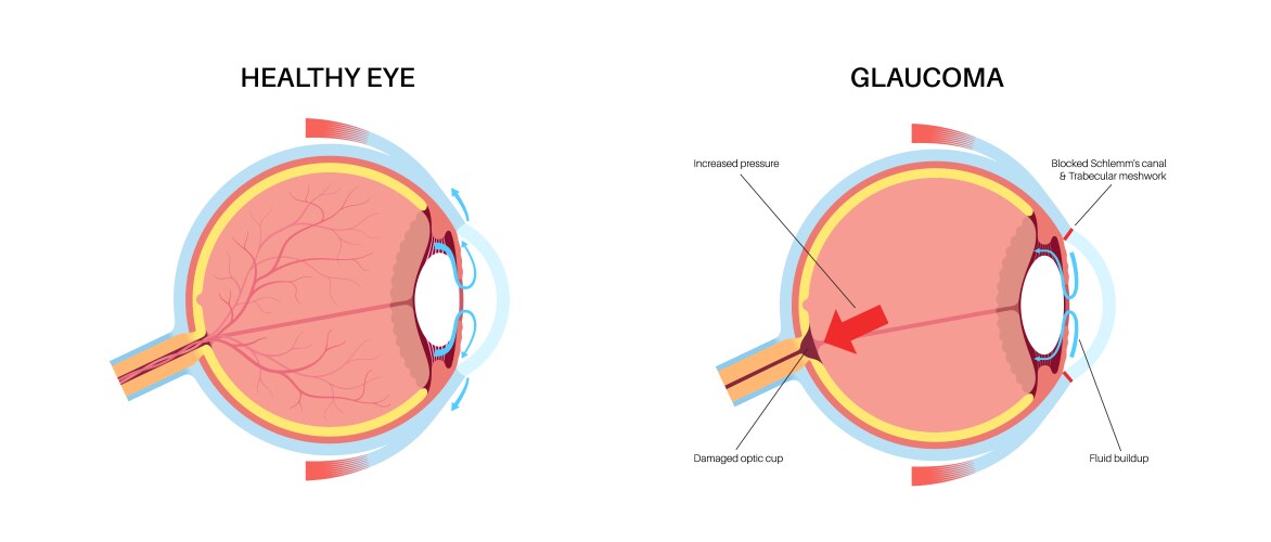 Glaucoma eye disease Royalty Free Vector Image