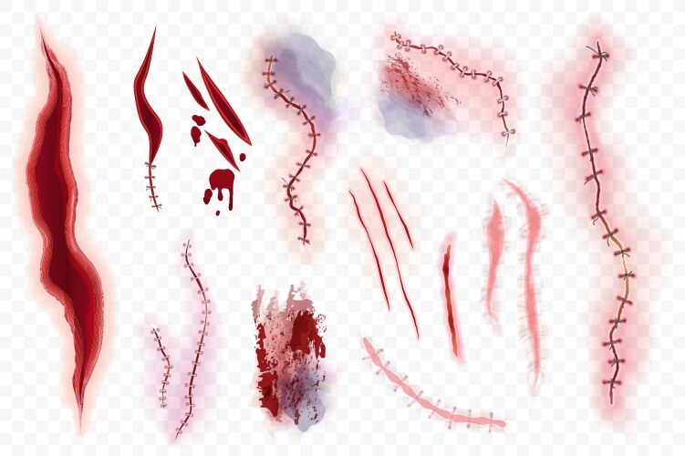 Surgical stitches infographic set Royalty Free Vector Image