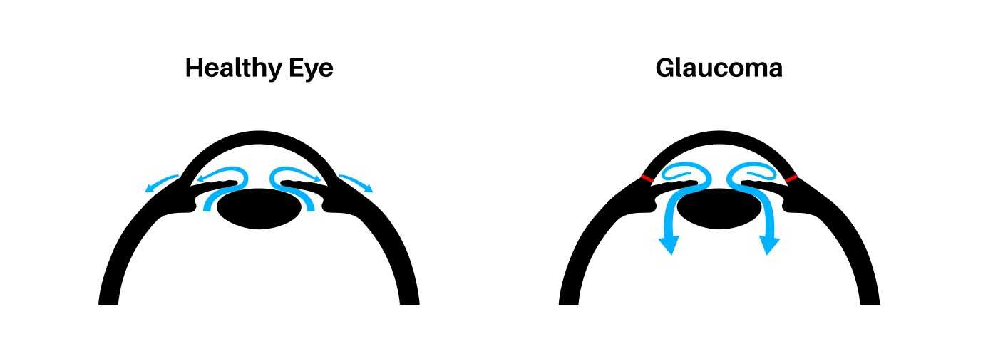 Glaucoma eye pressure Royalty Free Vector Image