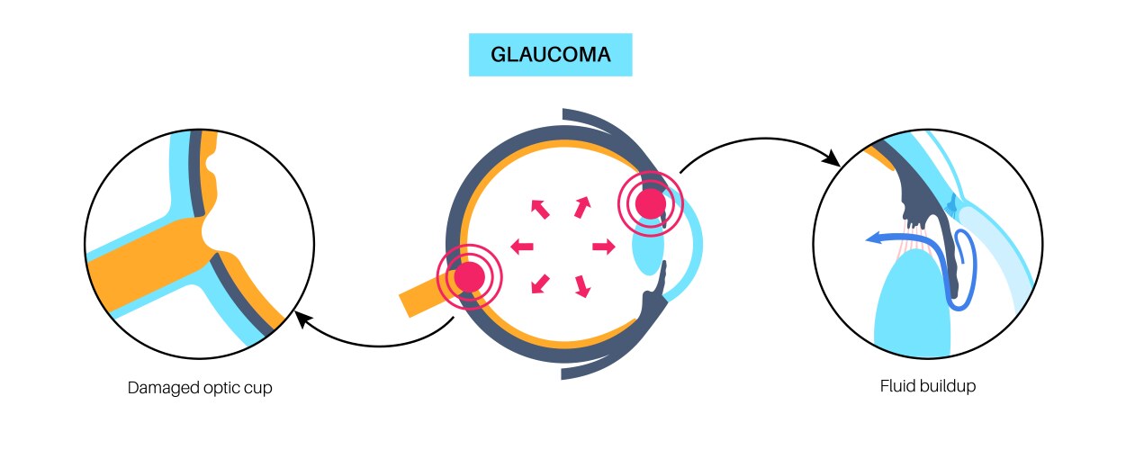 Glaucoma eye disease Royalty Free Vector Image