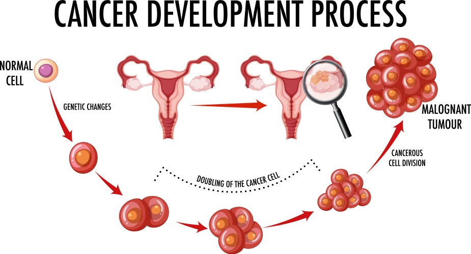 Cancer development process infographic Royalty Free Vector